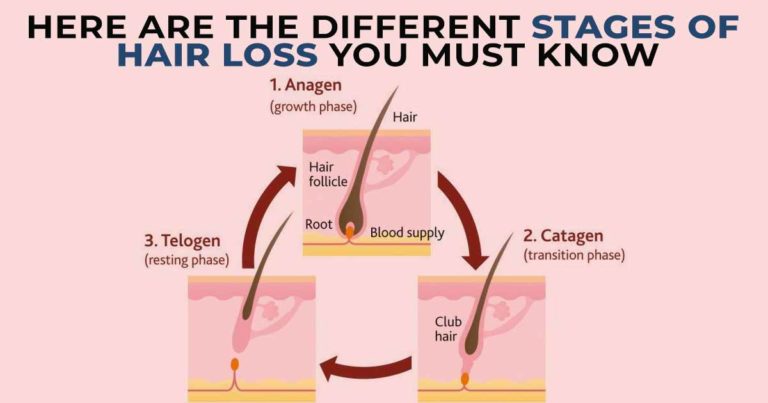 Here are the Different Stages of Hair Loss You Must Know - Year Tearm